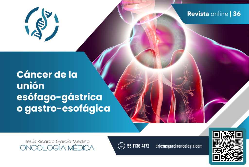 Cáncer De La Unión Esófago-Gástrica o Gastro-Esofágica - Dr. Jesús ...